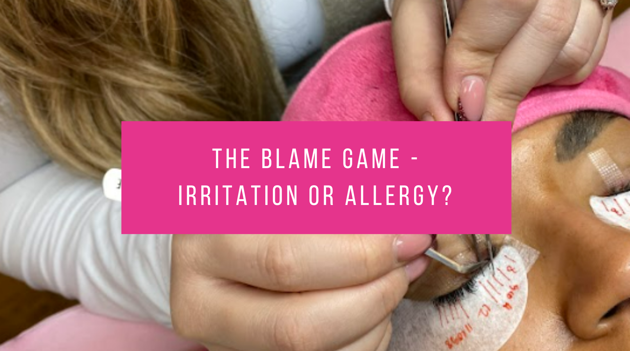 The Blame Game - Irritation or Allergy?